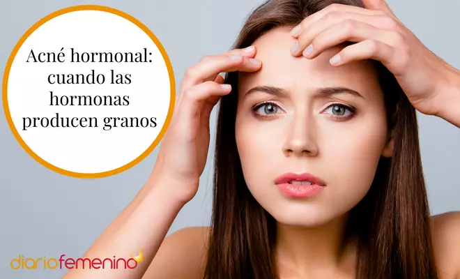 Știi ce este acneea hormonală?