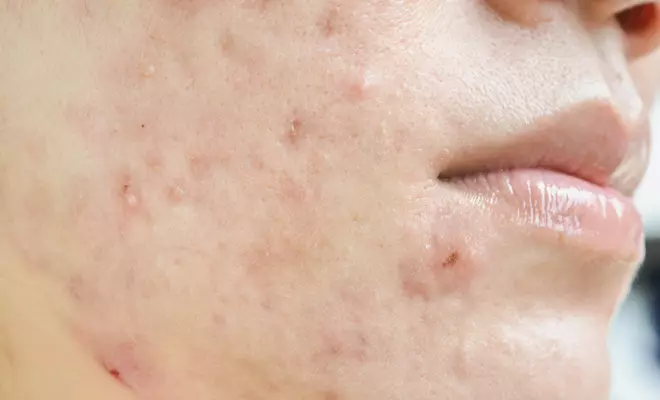 جڏهن ته هارمونز pimples پيدا