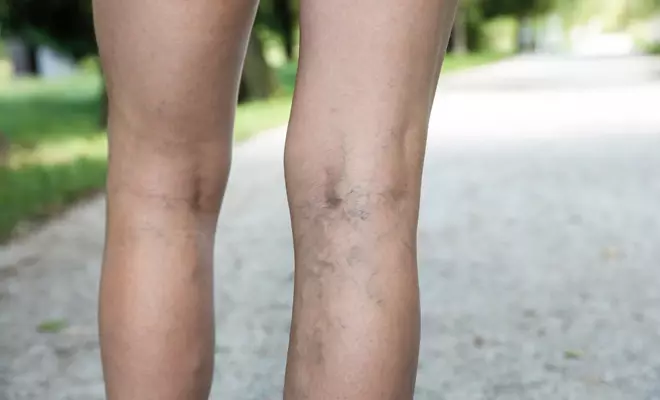 Hadarin tattooing akan varicose veins