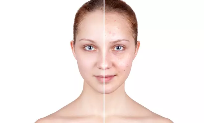 Rosacea näme we oňa nähili bejermeli?