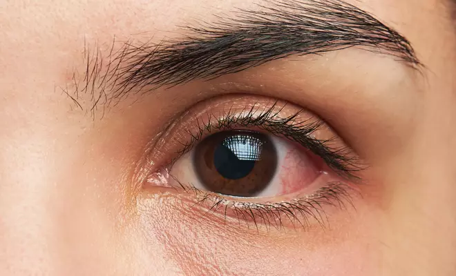 očesni konjunktivitis