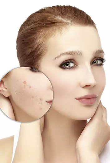 Como se livrar da acne rosácea: causas e tratamento para espinhas