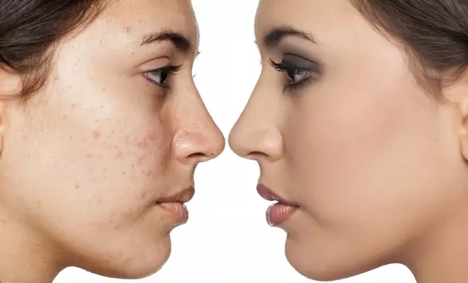 Ufite acne? Inama 15 zo kwisiga kugirango uhishe ibishishwa