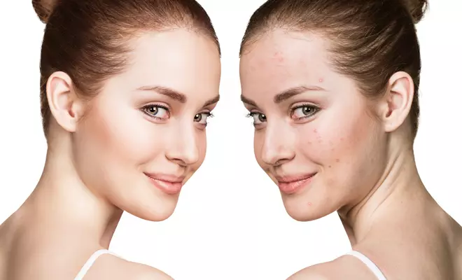 Чӣ тавр табобати пӯсти rosacea