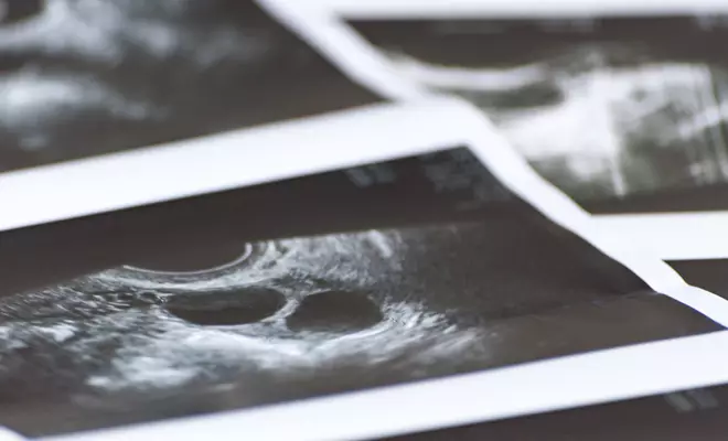 Rüyada ultrason görmek ne anlama gelir?