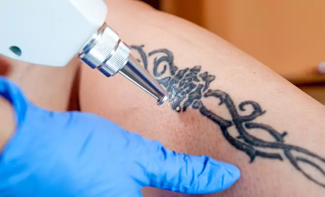 Laser om tattoos te ferwiderjen