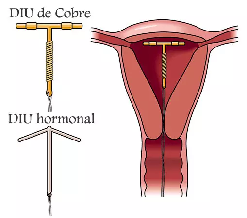 IUD copr neu IUD hormonaidd