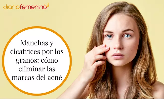Blemishes agus scars pimple: conas marcanna acne a bhaint