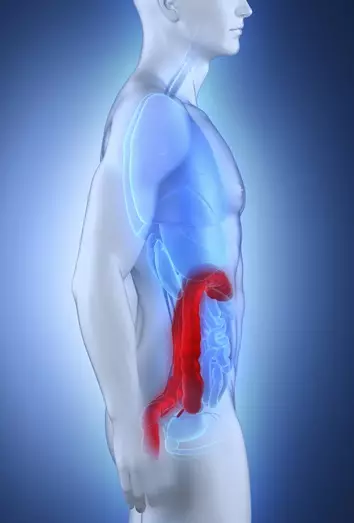 hemoroid internal