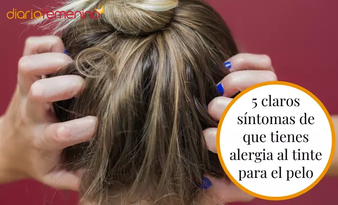 4 aiškūs simptomai, rodantys, kad turite alergiją plaukų dažams