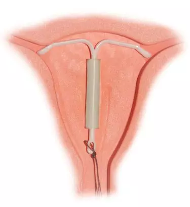 Paano nakakaapekto ang Mirena IUD sa regla?