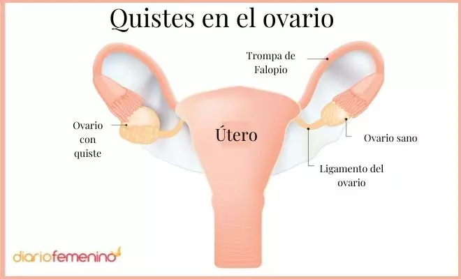Mga ovarian cyst: sintomas at uri