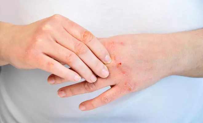 Cal é o mellor tratamento para a dermatite?