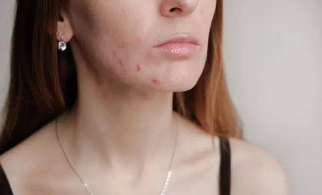 Cathain le dul chuig an dochtúir le haghaidh acne: téigh i gcomhairle le dermatologist le haghaidh pimples?