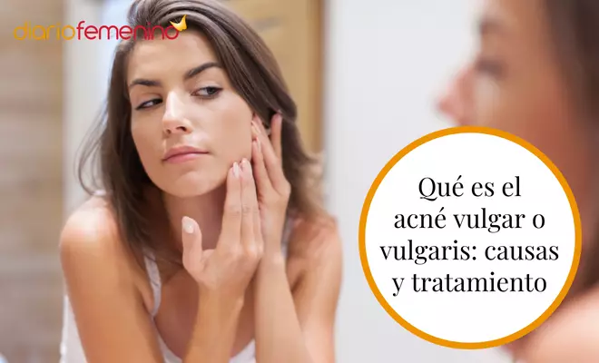 O que é acne vulgar ou vulgar: causas e tratamento