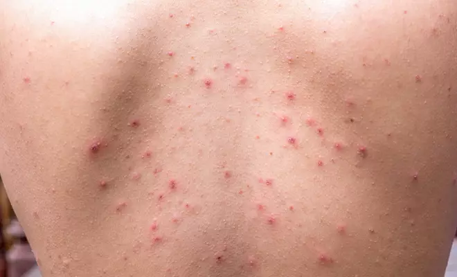 De effecten van acne vulgaris op de huid