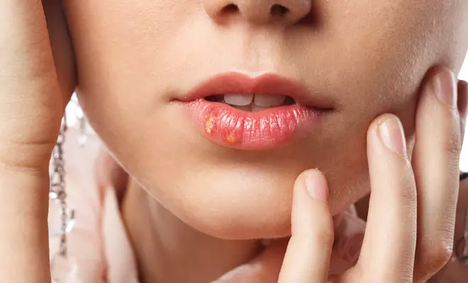 你的嘴唇揭示了你的健康狀況：唇皰疹