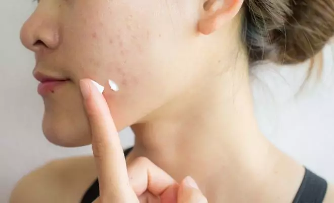 Da li šminka pogoduje pojavi akni?