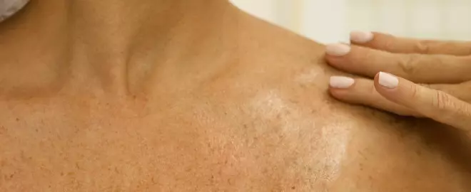 Como evitar manchas na pel