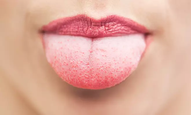なぜにきびが舌に現れるのですか？