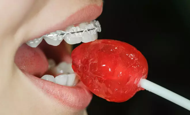 Tránh ăn đồ ngọt nếu bạn đeo niềng răng