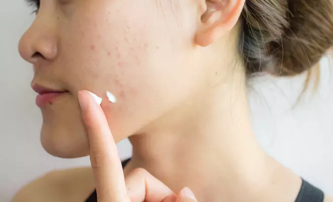 Tipps zur Behandlung von Aknehaut