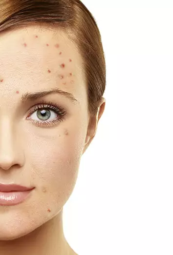 The cysts produced by cystic acne are very painful.