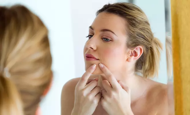 Patarimai, kaip prižiūrėti į spuogus linkusią odą