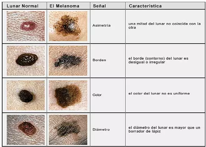 I-mole eqhelekileyo okanye i-melanoma