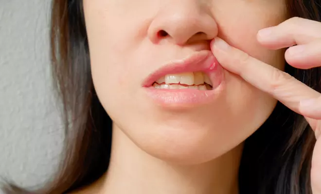 Quant de temps dura una nafra a la boca?