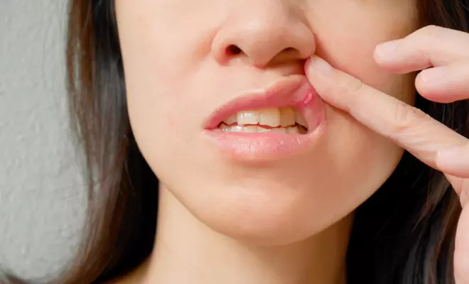 舌头上的疮：治愈它们的家庭疗法