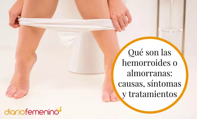 W Diario Feminine powiemy Ci, czym są hemoroidy