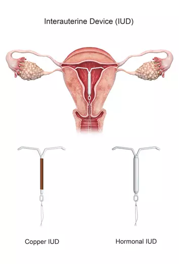 IUDの種類