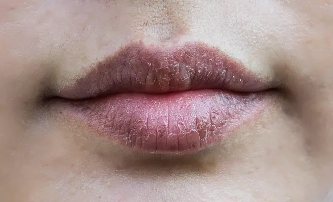 Úzkostný syndróm suchých úst: boj proti zápachu z úst