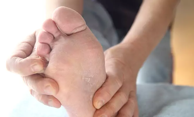 Glivice na stopalih: odkrijte njene simptome